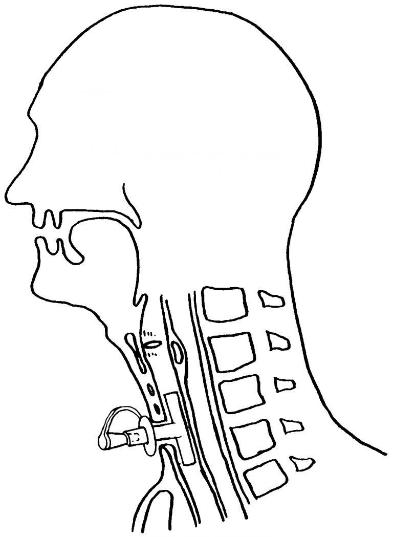 Tracheal T-Tube – Stening